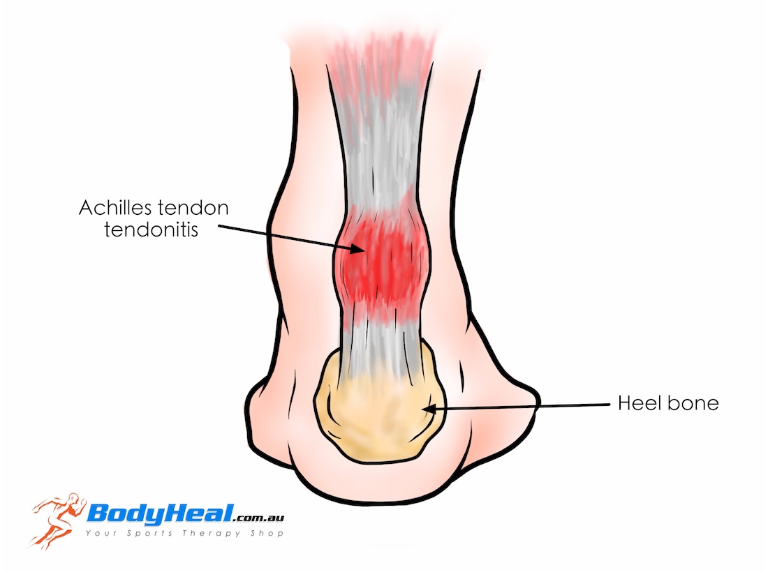 Achilles Tendon Welk Security Trust